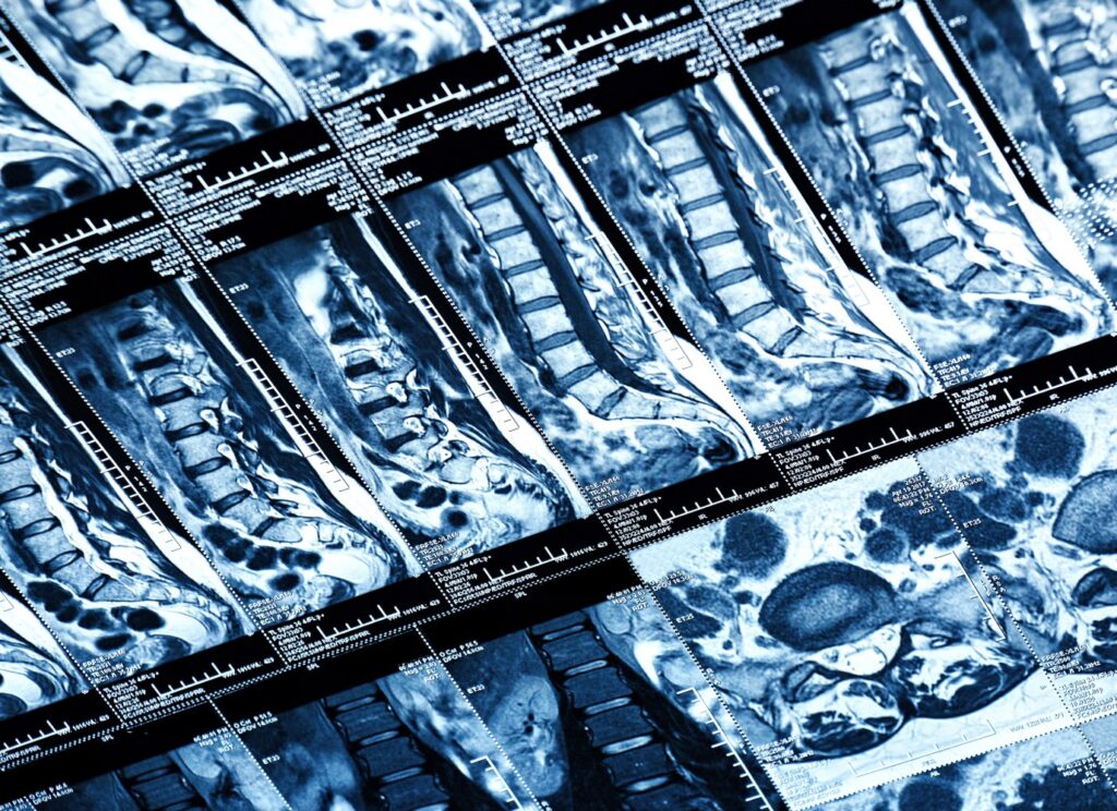 Scanner rachis | Imagerie médicale | Radiologie | Révélis | Paris