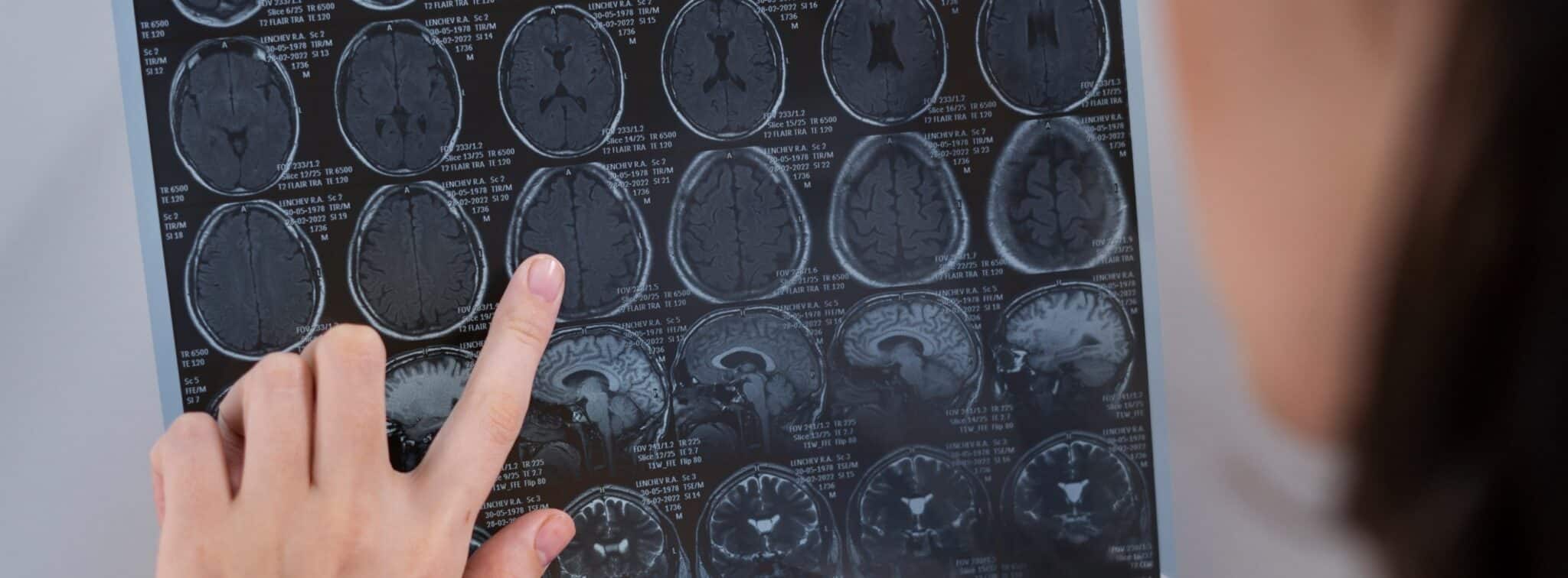 Comment se déroule un scanner cérébral ? | Radiologie | Révélis | Paris