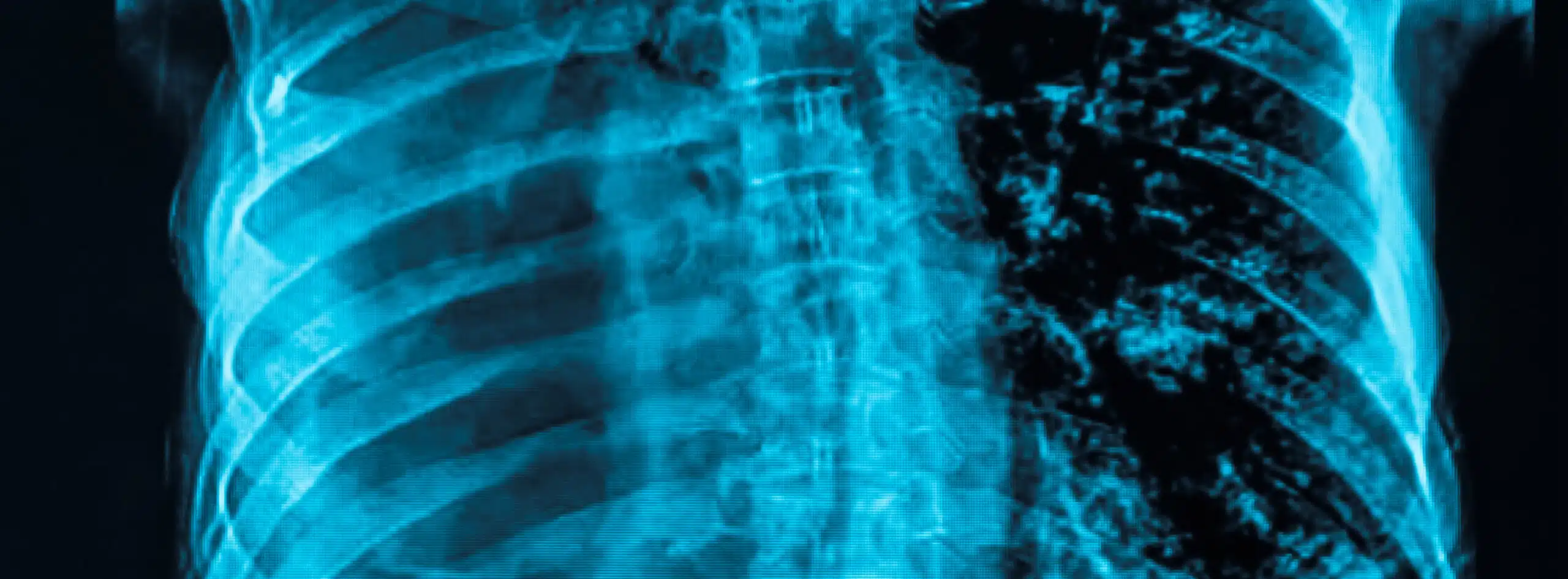 Combien de temps dure l’efficacité d’une infiltration ? | Radiologie ...